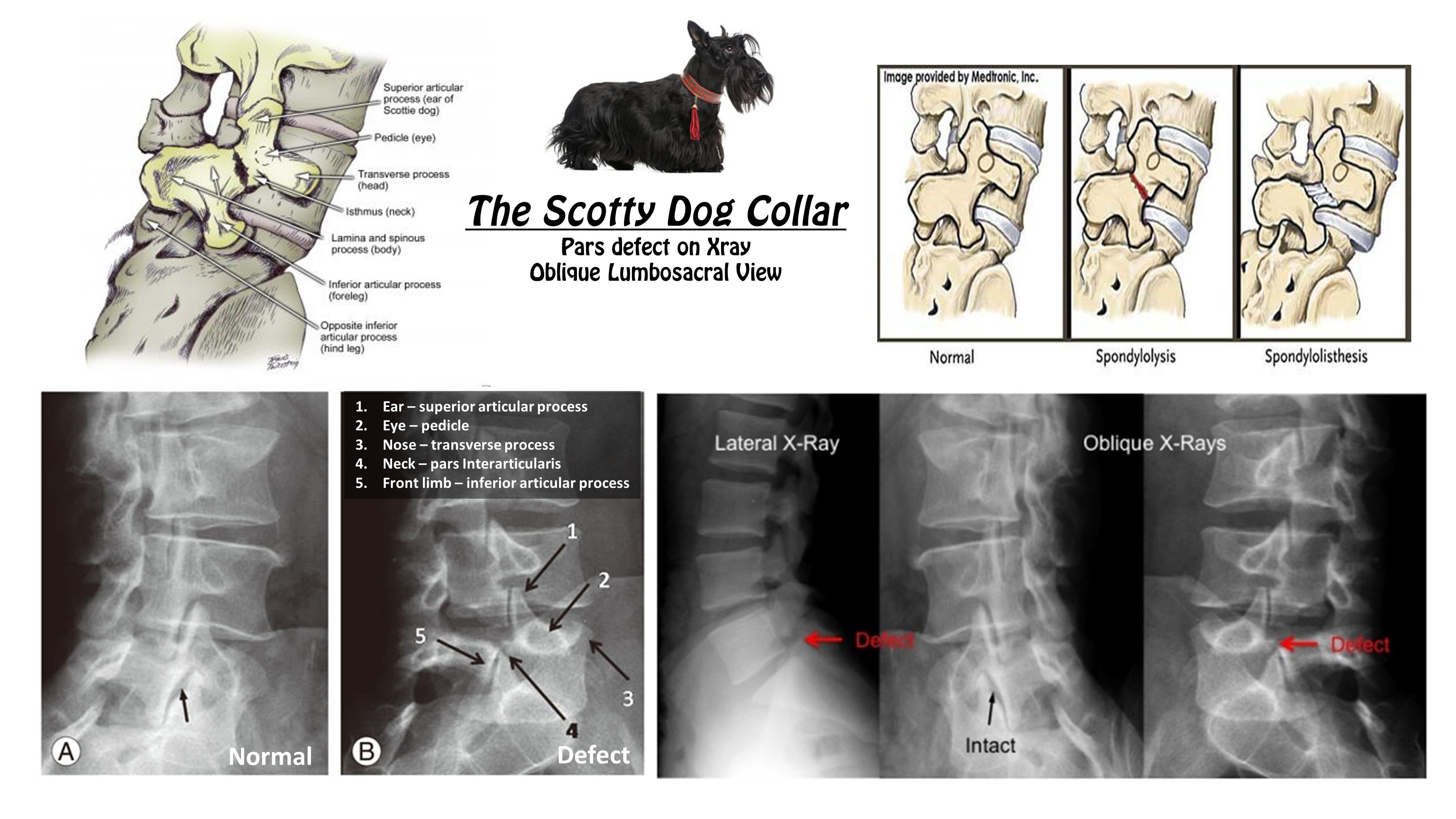 Lumbar Spine Stress Fractures — Spondylolysis | by The Tennis Physio ...