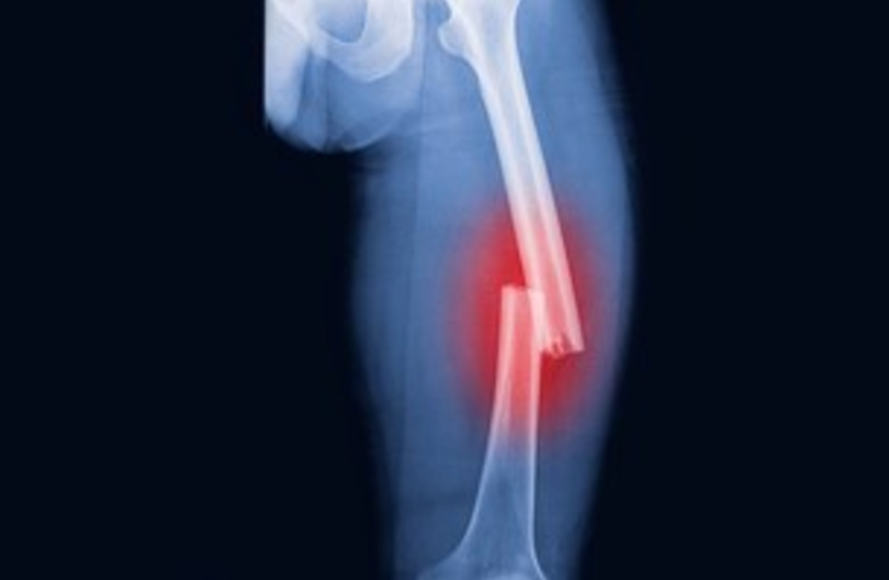 How Broken Bones Heal. An explanation of the body’s natural… | by OSD ...