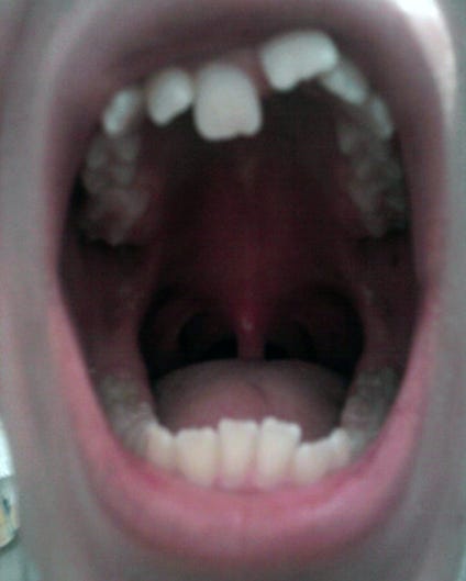 How To Save Thousands On Braces And Get a Beautiful Hollywood Smile ...