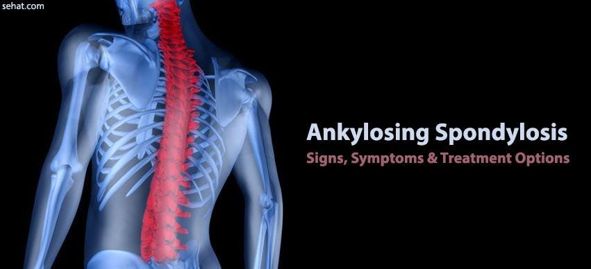 Understanding Ankylosing Spondylosis | Sehat | by Sehat.com | Medium