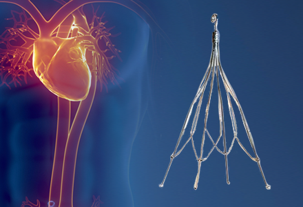 The Legalities Involving Blood Clot Filters | by IVC Filter Settlements ...