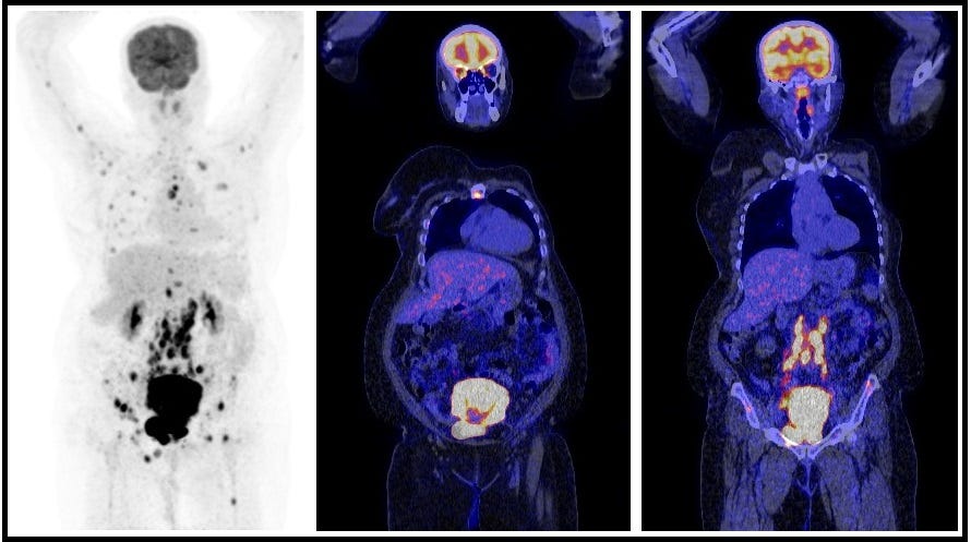 Case Study: A middle aged female patient with multiple primary cancers ...