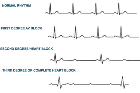 An Overview of the Workings and Afflictions of the AV Node | by ...