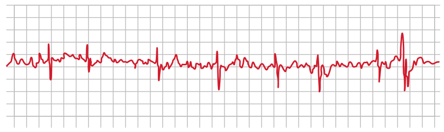 Supraventricular Tachyarrhythmias: An Overview | by Nandan Tumu ...