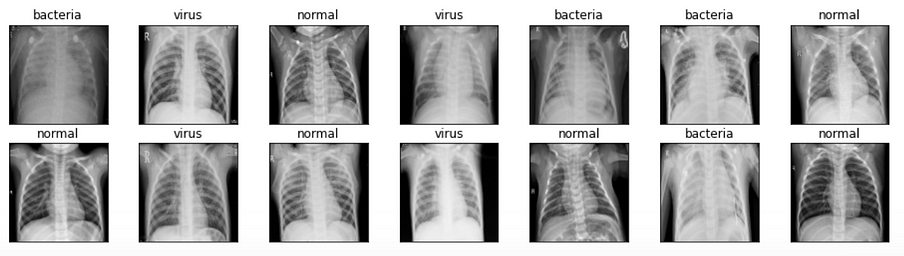How Does Pneumonia Detection Using Cnn Work In Python 0145