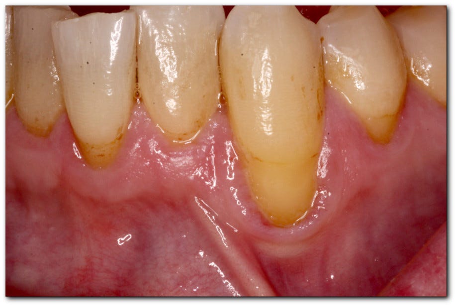 New Less Invasive Techniques Can Successfully Reverse Gingival ...