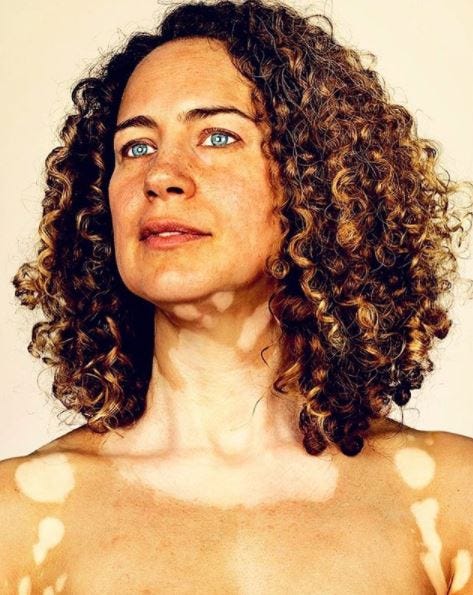 8 Girls with Vitiligo Bare All in Brock Elbank Photo Shoot, See ...