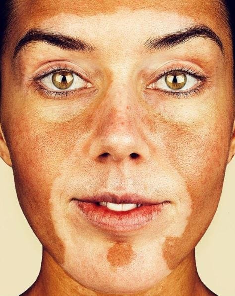 8 Girls with Vitiligo Bare All in Brock Elbank Photo Shoot, See ...
