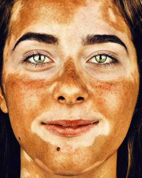 8 Girls with Vitiligo Bare All in Brock Elbank Photo Shoot, See ...