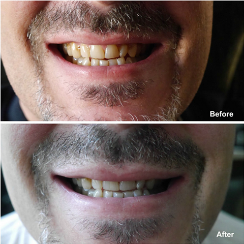 Coconut Oil Pulling. Coconut Oil Pulling, How does it work? | by Stormy ...