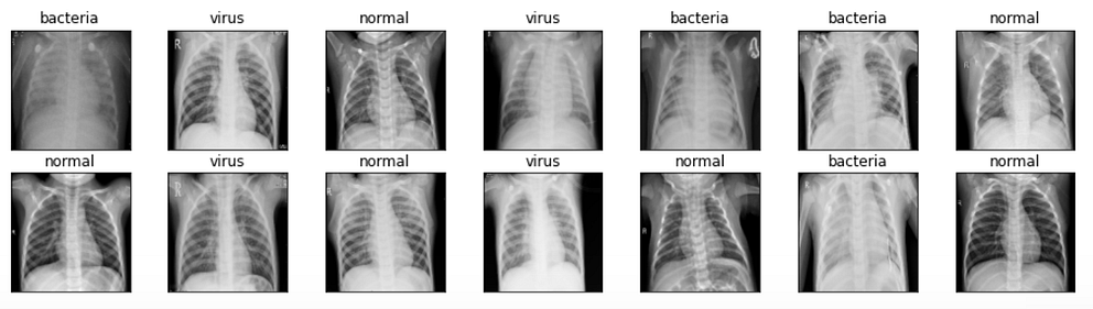 How does Pneumonia Detection using CNN work in Python