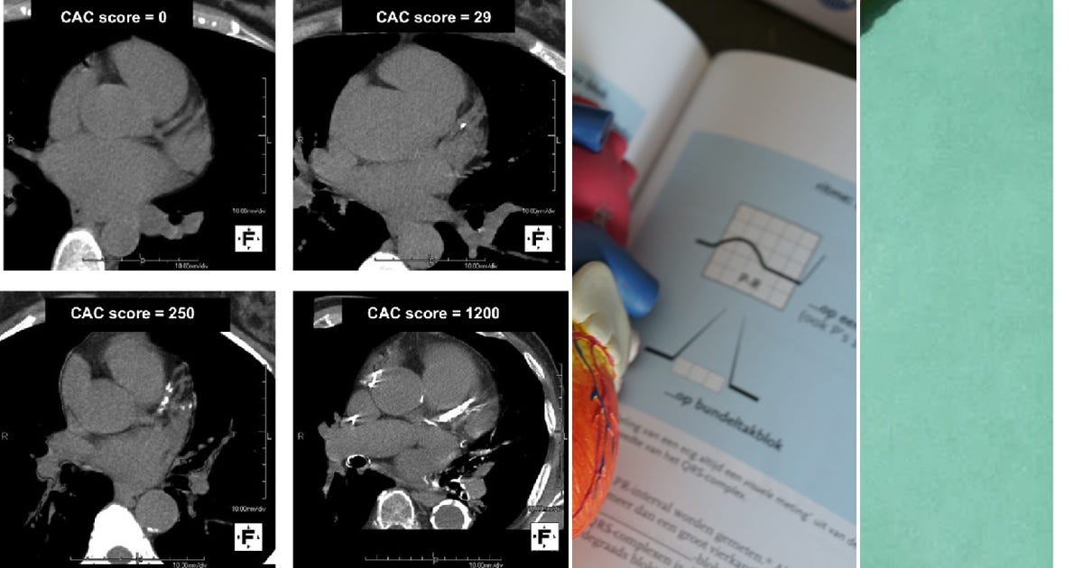 List: Coronary Artery Calcium (CAC) scoring | Curated by Nobilik | Medium
