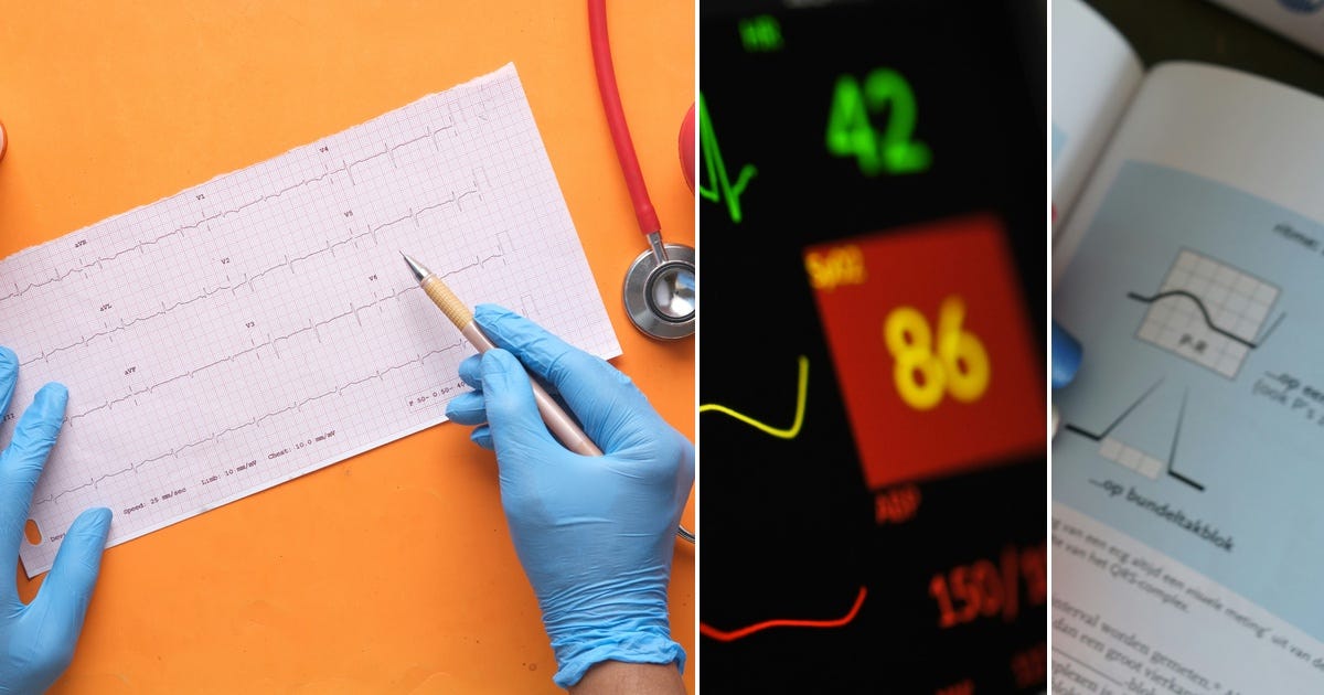 List: MIT-BIH Electrocardiogram Data | Curated by Proto Bioengineering ...