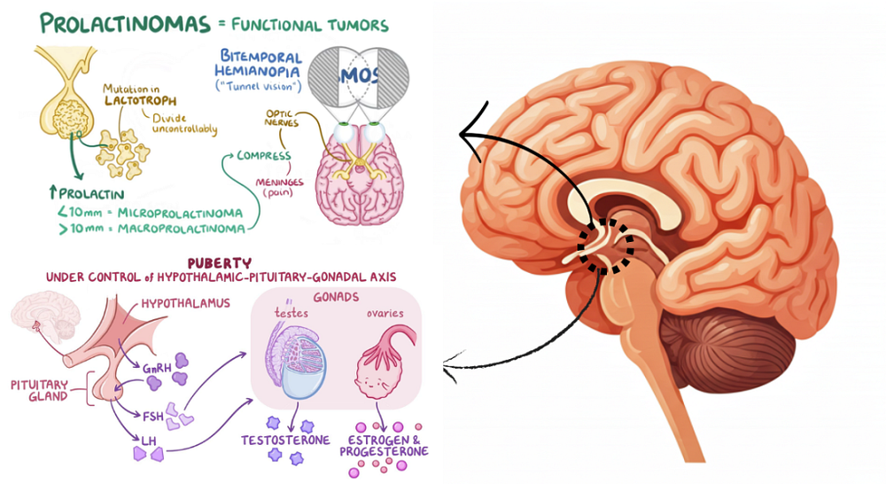 A Rare Diagnosis: My Journey with Pituitary Adenoma and Surgery | by ...
