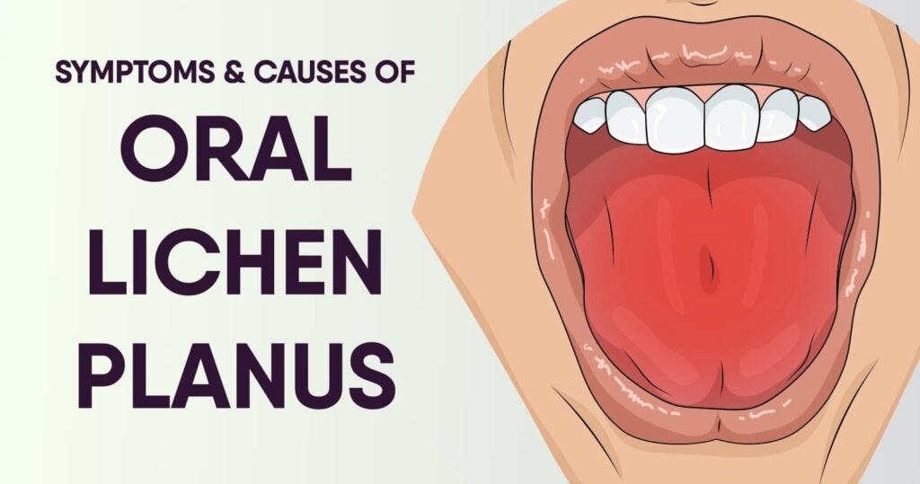 What is oral lichen planus, and how is it caused? | by Ateendar Singh ...