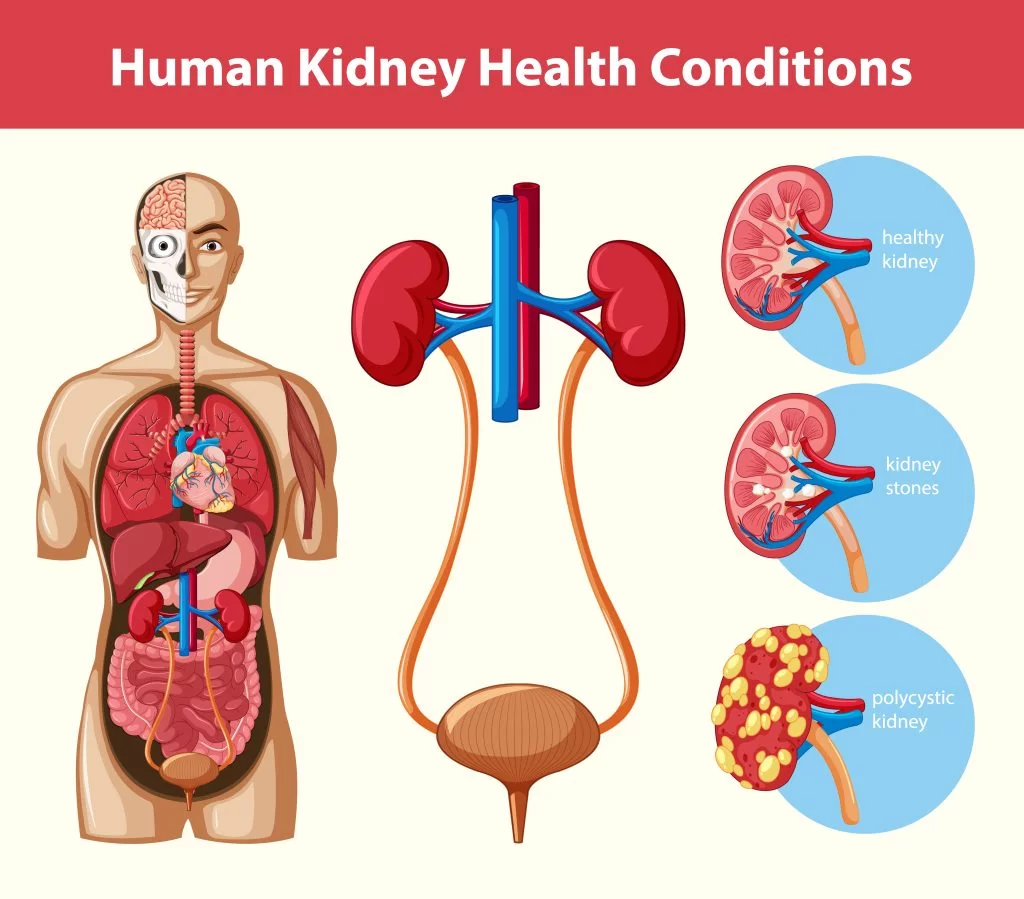Can the kidney be demage. CAN THE KIDNEY BE DAMAGEfo | by tutuk yuwono | May, 2024 | Medium