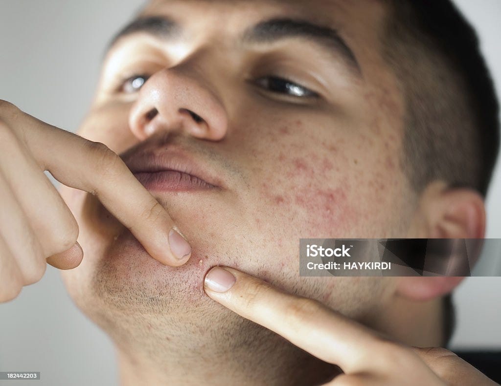 Natural Home Remedies. Acne & Pimples | by ES | Feb, 2025 | Medium