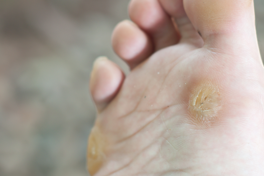 Understanding Warts: Causes, Types, and Prevention Tips | by ...