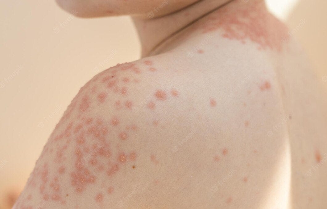 What is hives on Skin — Symptoms, Causes, Treatment | by Clara Wilson ...