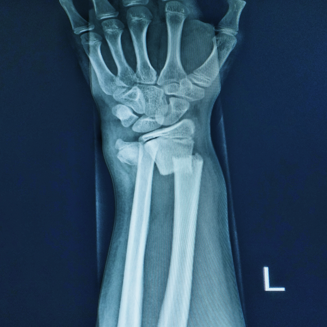Decoding Wrist Injuries: Understanding Sprains vs. Fractures | by ... Decoding Wrist Injuries: Understanding Sprains vs. Fractures | by ...