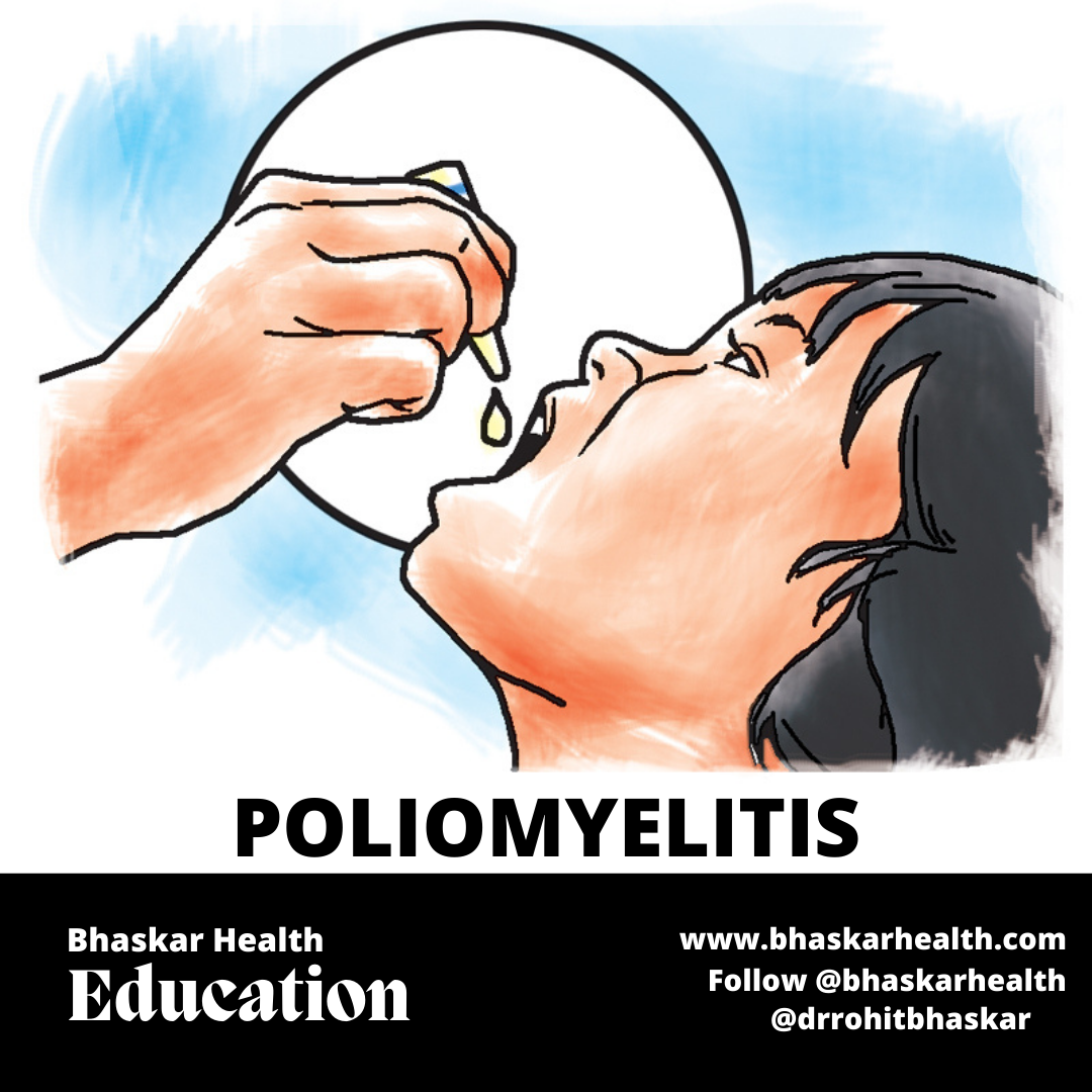 Polio (Poliomyelitis): Symptoms, Causes & Vaccine | by Bhaskar Health ...