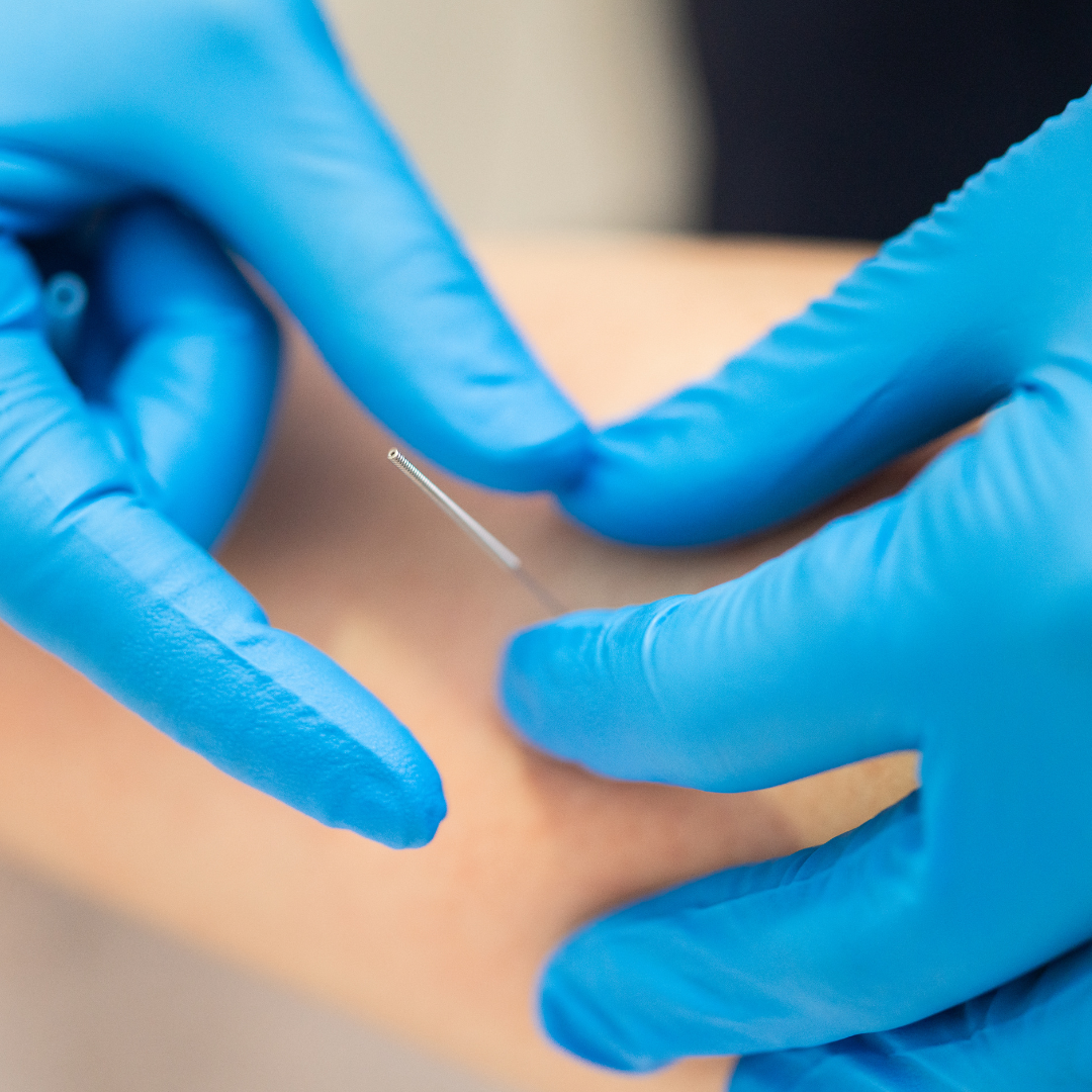 Revolutionising Rehabilitation: Dry Needling in Singapore for Shoulder ...