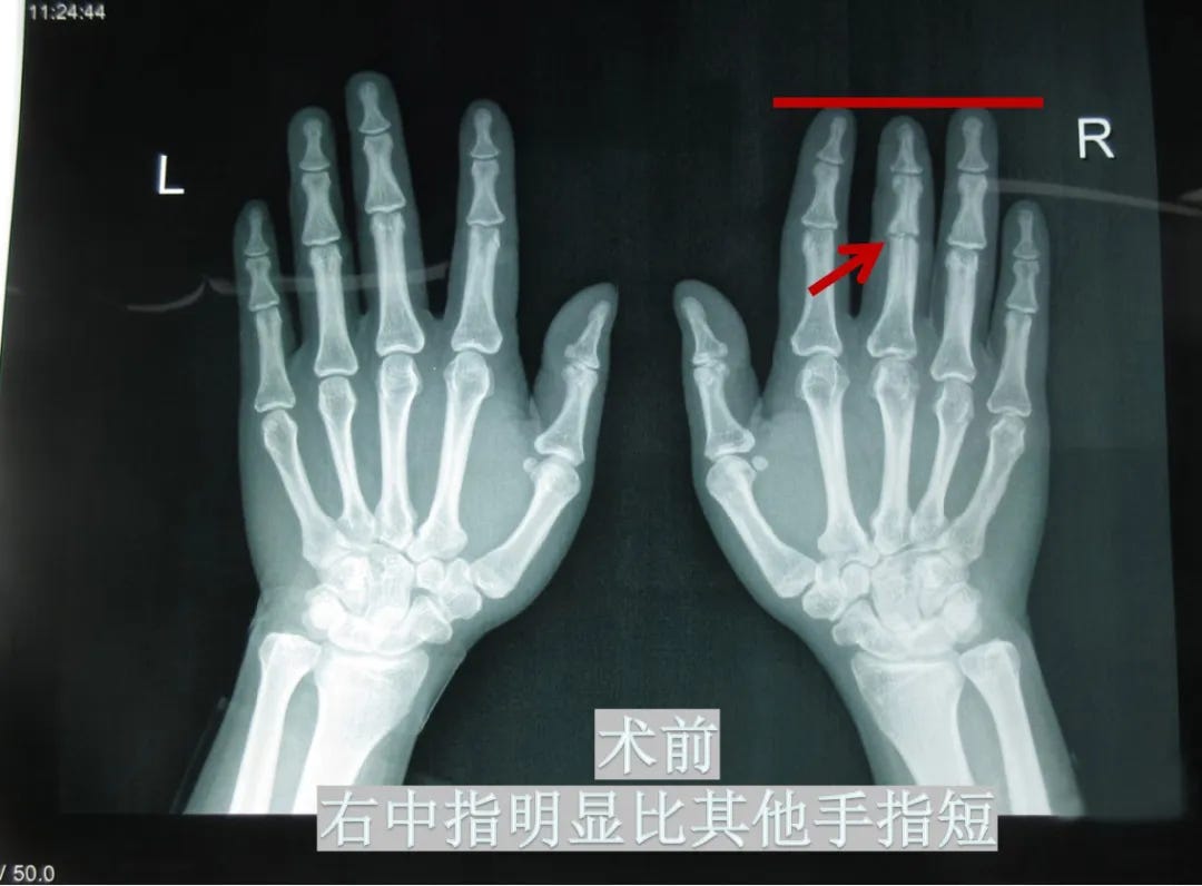 A Remarkable Case of Finger Joint Reconstruction | by Bill Huang | Jul ...