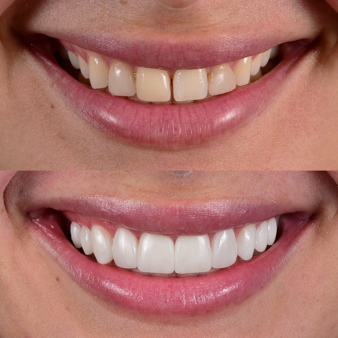 The Radiant Revolution: Composite Veneers Redefining Beauty Standards ...