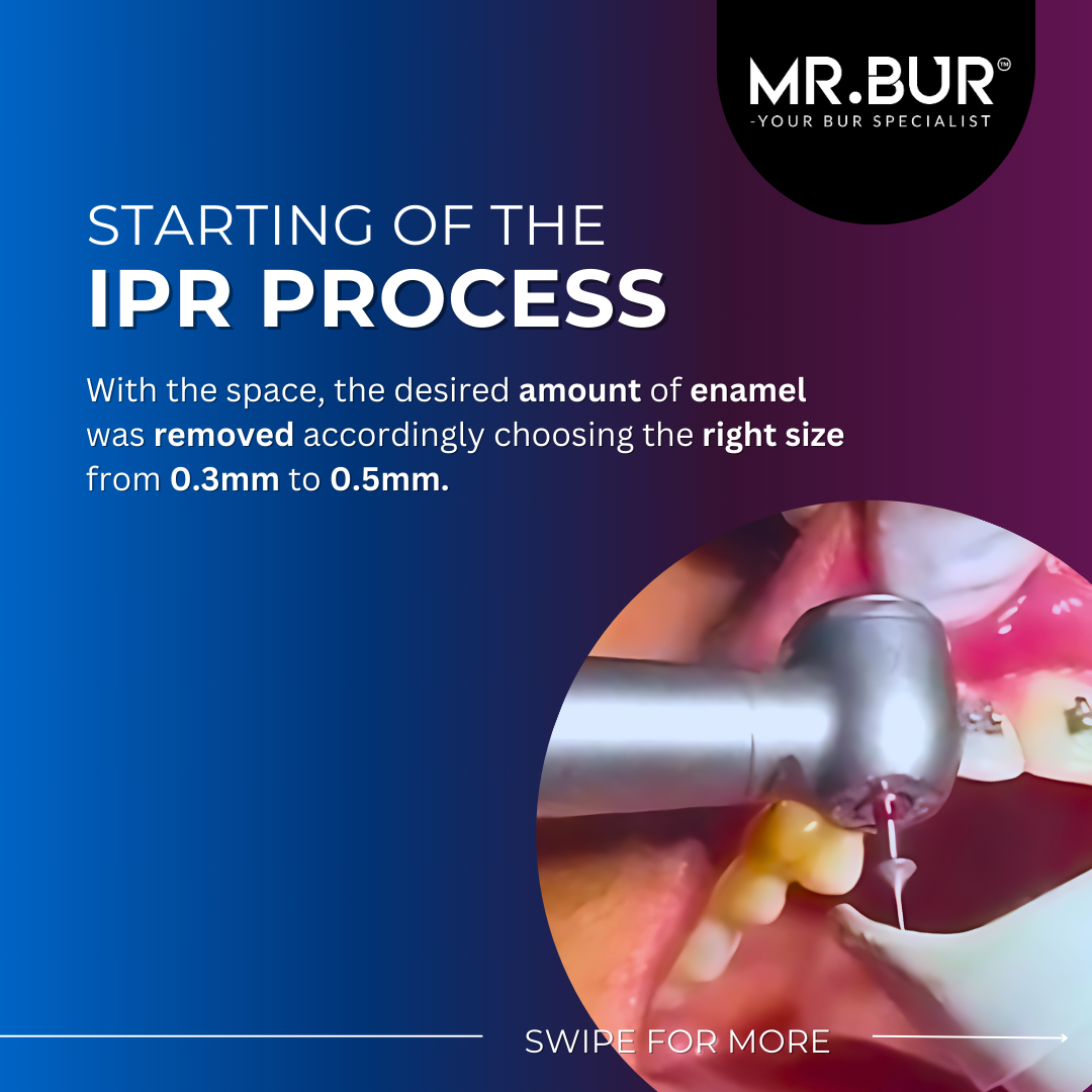 Step-by-step guide to Interproximal Bur Technique: The bur used for IPR ...