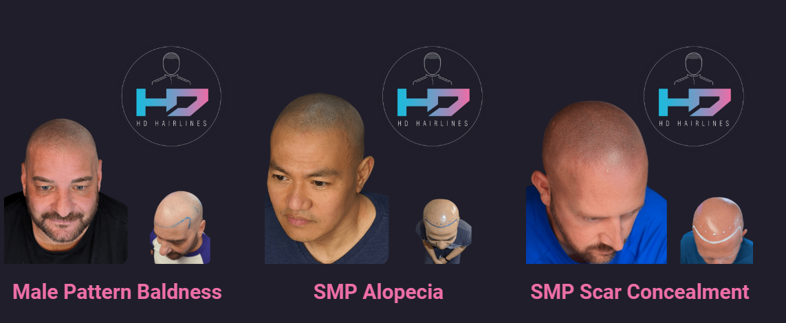 Transform Your Look with HD Hairlines: Unveiling the Life-Changing ...