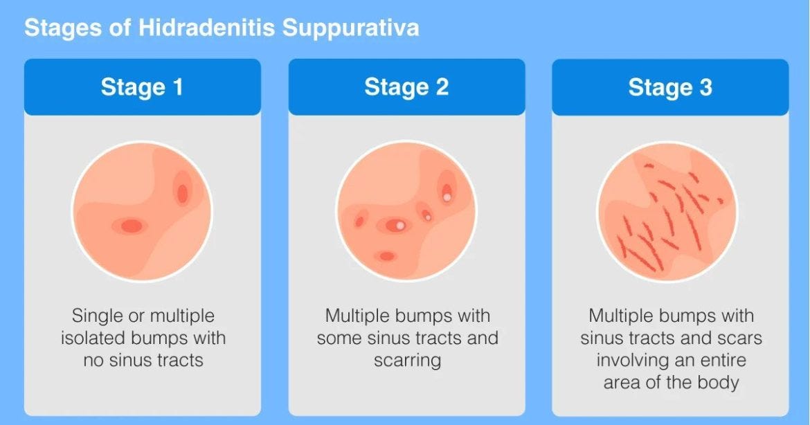 Hidradenitis Suppurativa: Causes, Symptoms, and Treatment | by Victor ...
