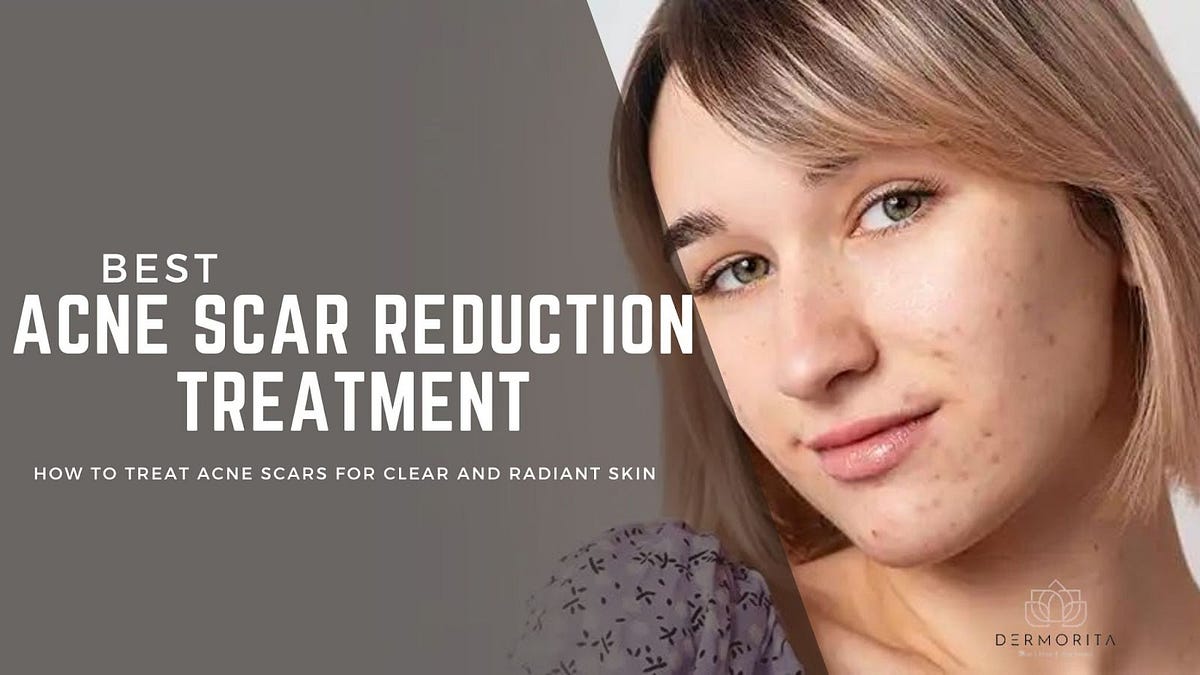 How To Treat Acne Scars For Clear And Radiant Skin? | by Dermorita ...