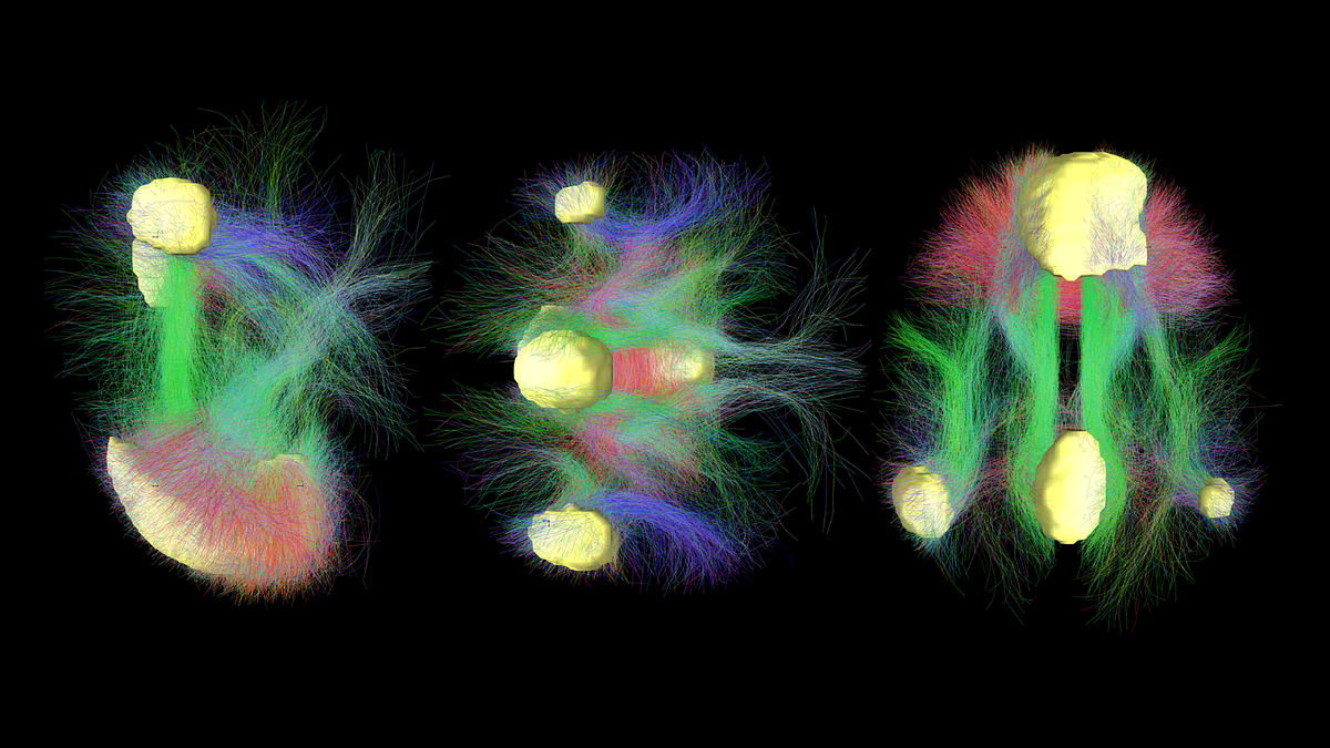When Trauma Changes Who We Are: The Brain’s Default Mode Network | by ...