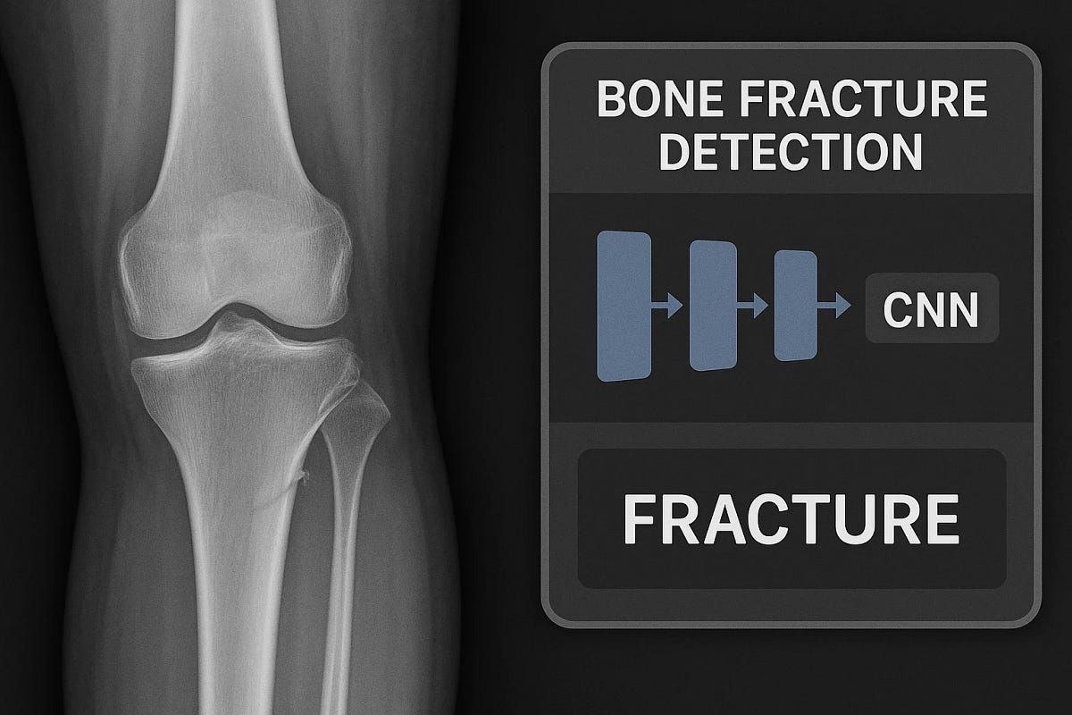 CNN based Bone Fracture Detection on X-rays | by Dr. Ameer Hamza ...