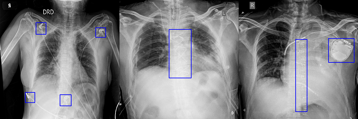 Reducing False Positives in Nodule Detection from Chest X-Rays | by Ashrika Gaikwad | DeepTek ...