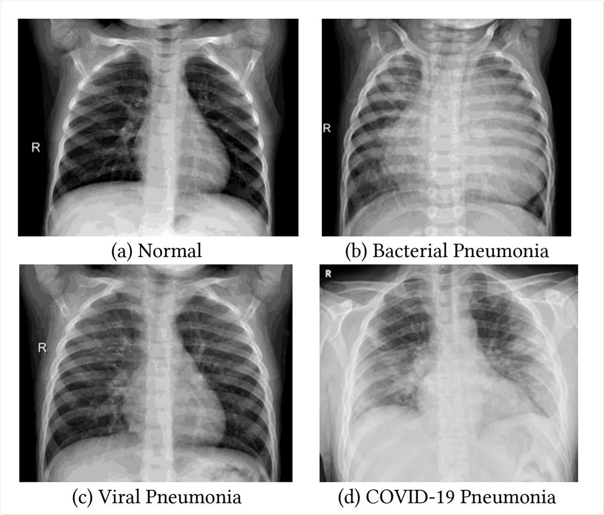 Detecting Pneumonia in Chest X-Rays Using Various Deep Neural Nets | by ...