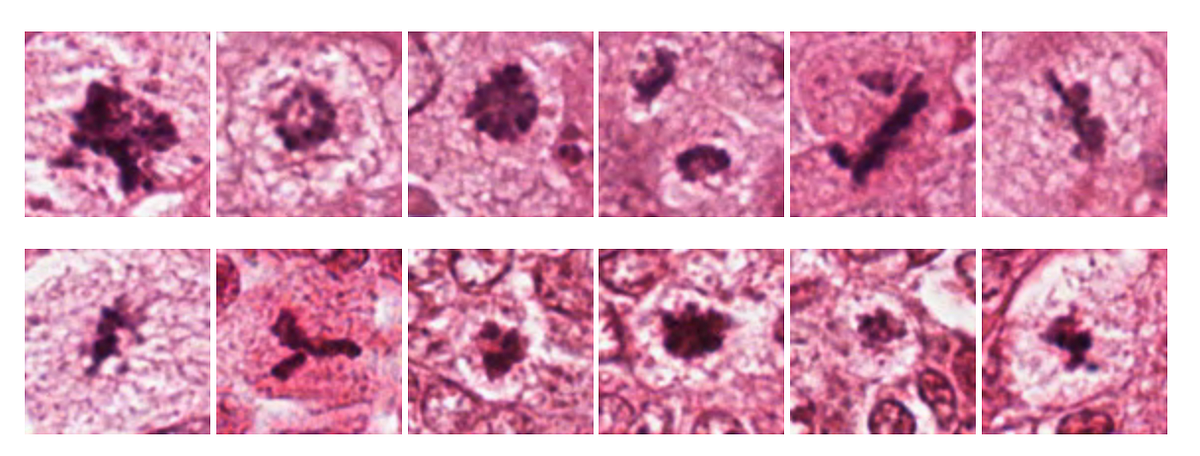 PAIthology: AI tool for early breast cancer diagnosis (Part 1: problem ...