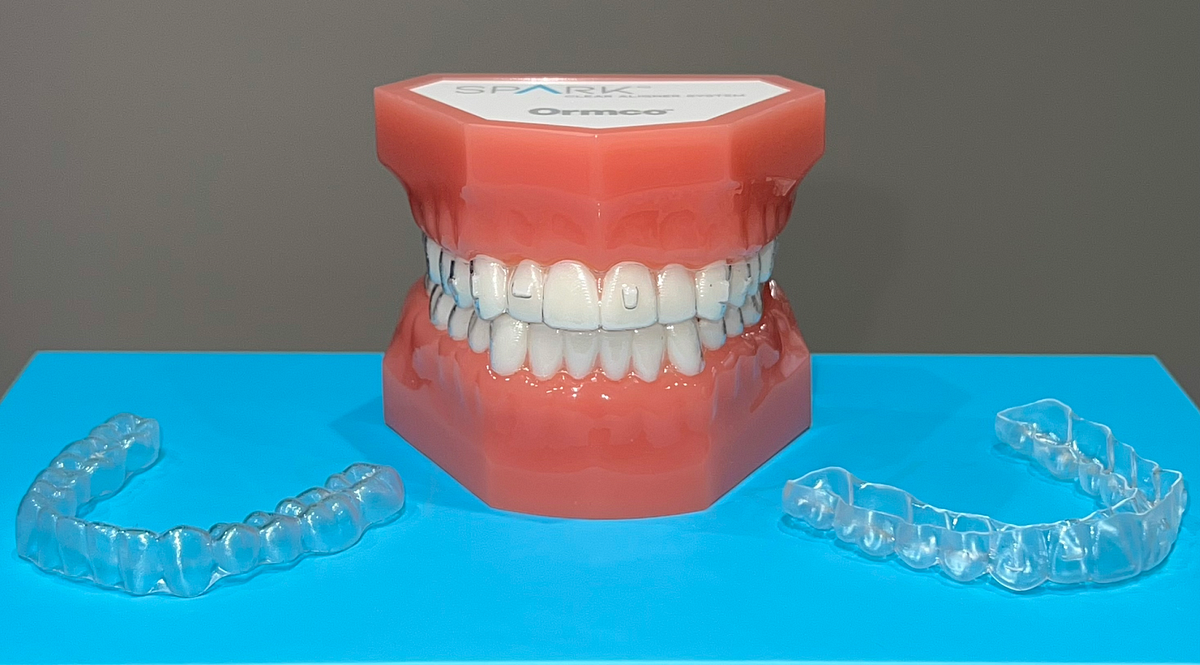 Aligners vs Braces: Pros and Cons | by Dr. Cyrus Aghdam | Medium