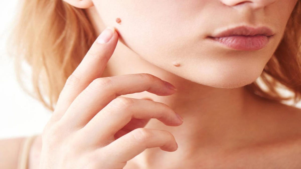 The Art of Mole Eradication: Advanced Techniques for Clear Skin | by ...