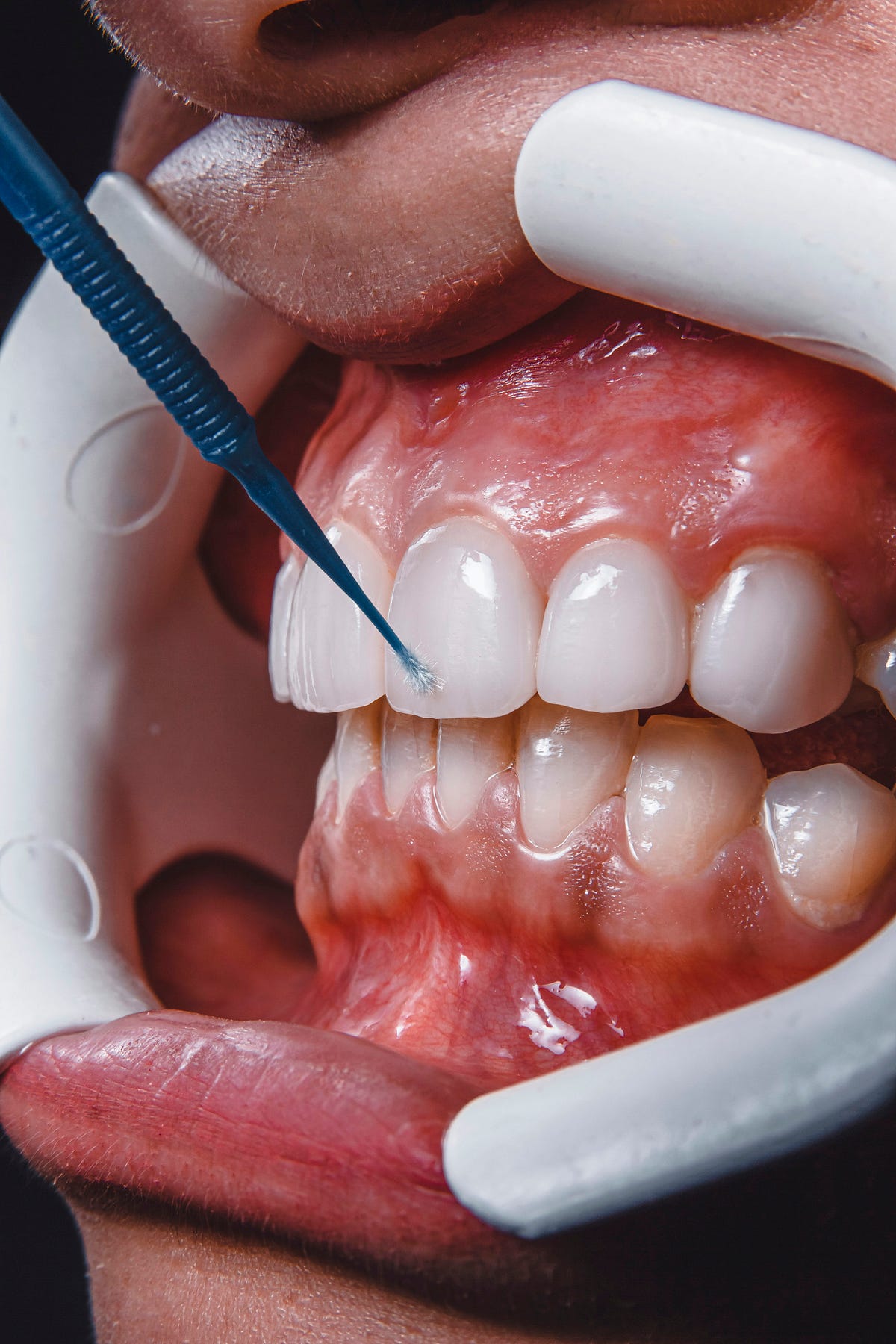Enlisting Professional Help In The Quest For Functional Teeth | by ...
