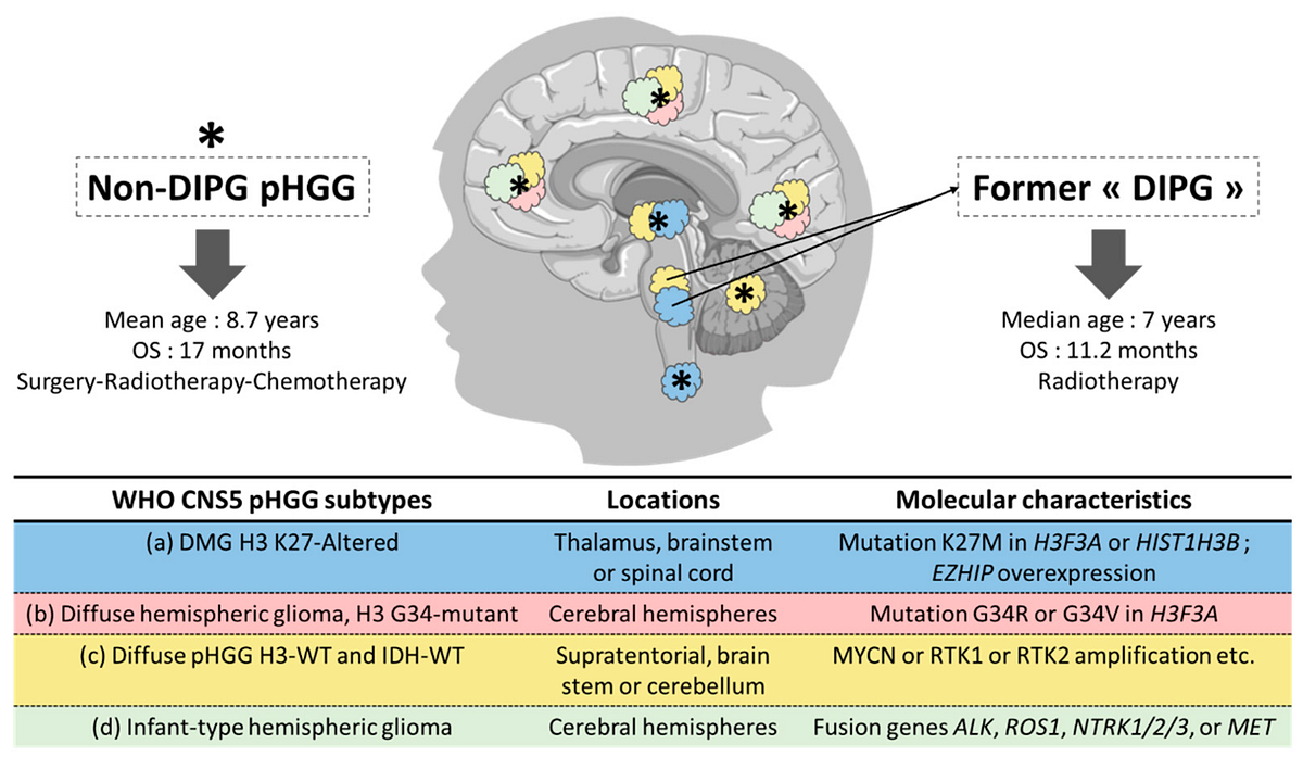 🧠 Unraveling the Mysteries of Glioma Grading: A Detailed Exploration ...