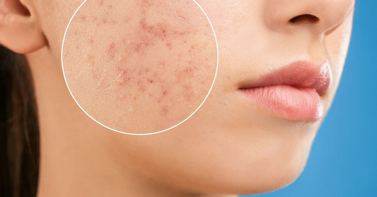 Despertando para uma Pele Livre de Acne: O Guia Definitivo para uma ...