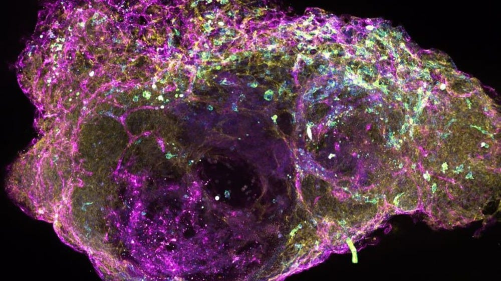 Lab-grown bone marrow may unlock personalized blood cancer treatments ...