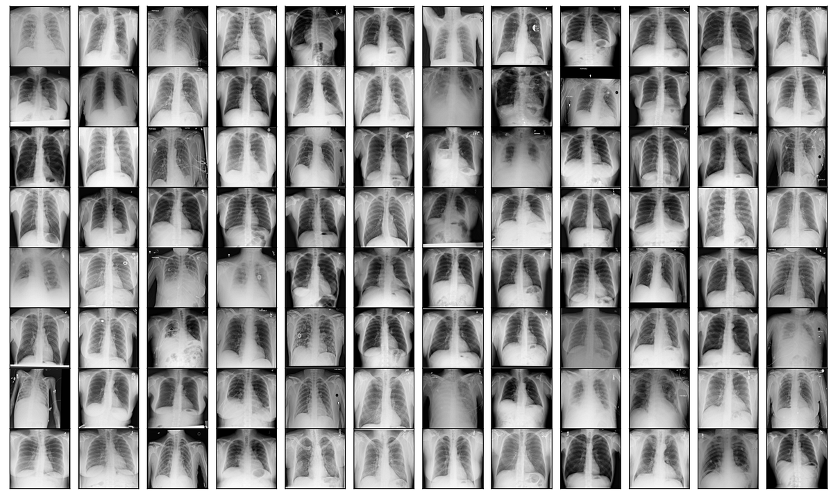 Chest X-Ray Classification with DINOv3 | by Geronimo | Medium