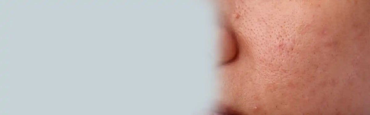 Causes of Open Pores You Didn’t Know About | by Dermorita clinic | Apr ...