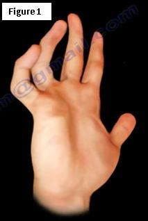 Ulnar Claw Hand. Ulnar claw hand is an abnormal hand… | by Nabil ...