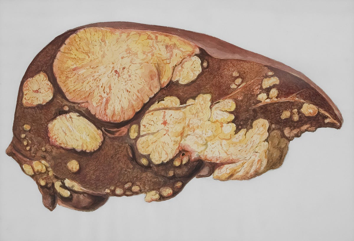 138 Million Indians Are Living With Kidney Disease | by Aamil_MS | The Way We Live | Nov, 2025 ...