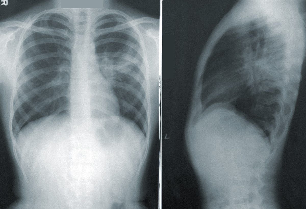 Medical Report Generation Using Chest X-rays — Self Case-Study | by ...