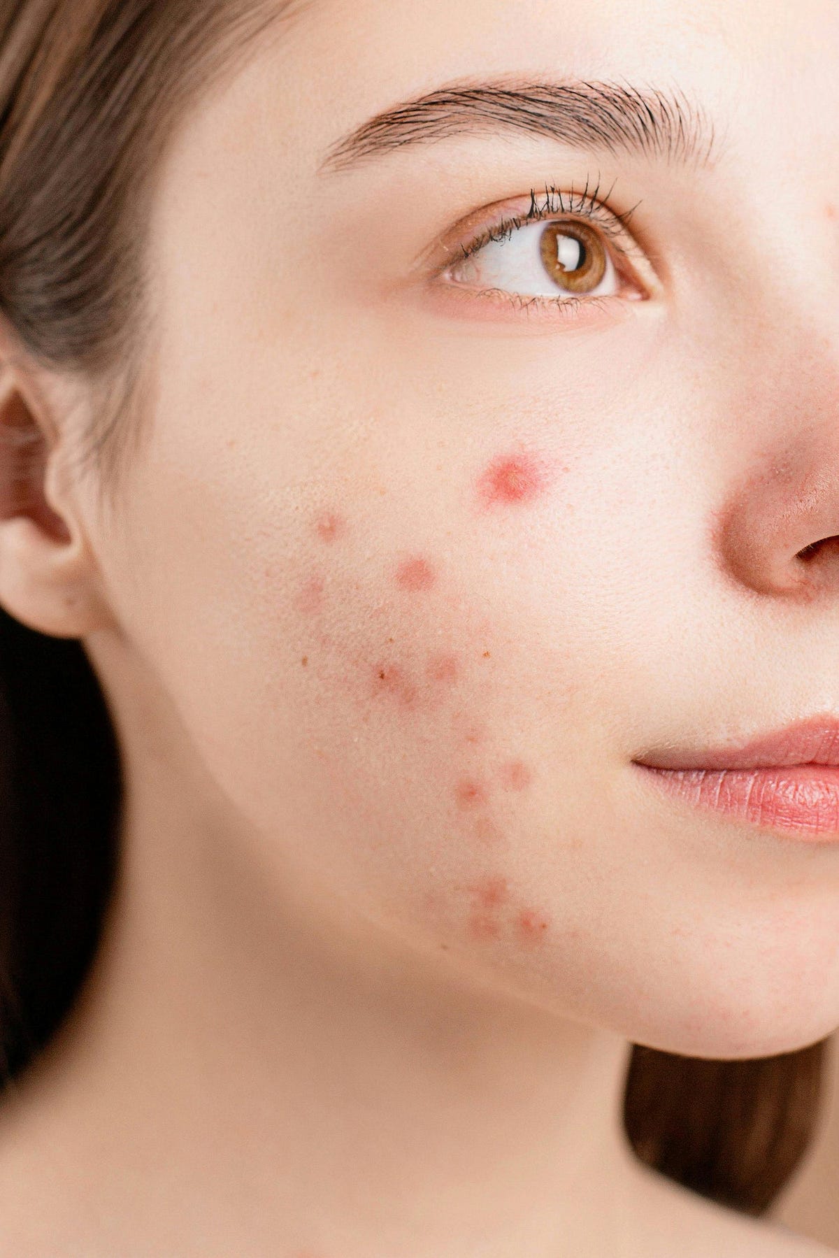 How to Prevent Acne Breakouts. Acne is one of the most common skin ...