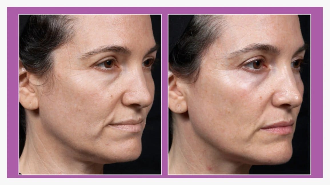 How Does Radio Frequency Skin Tightening Work: The Ultimate Guide | by Imperial Bliss | Jul ...